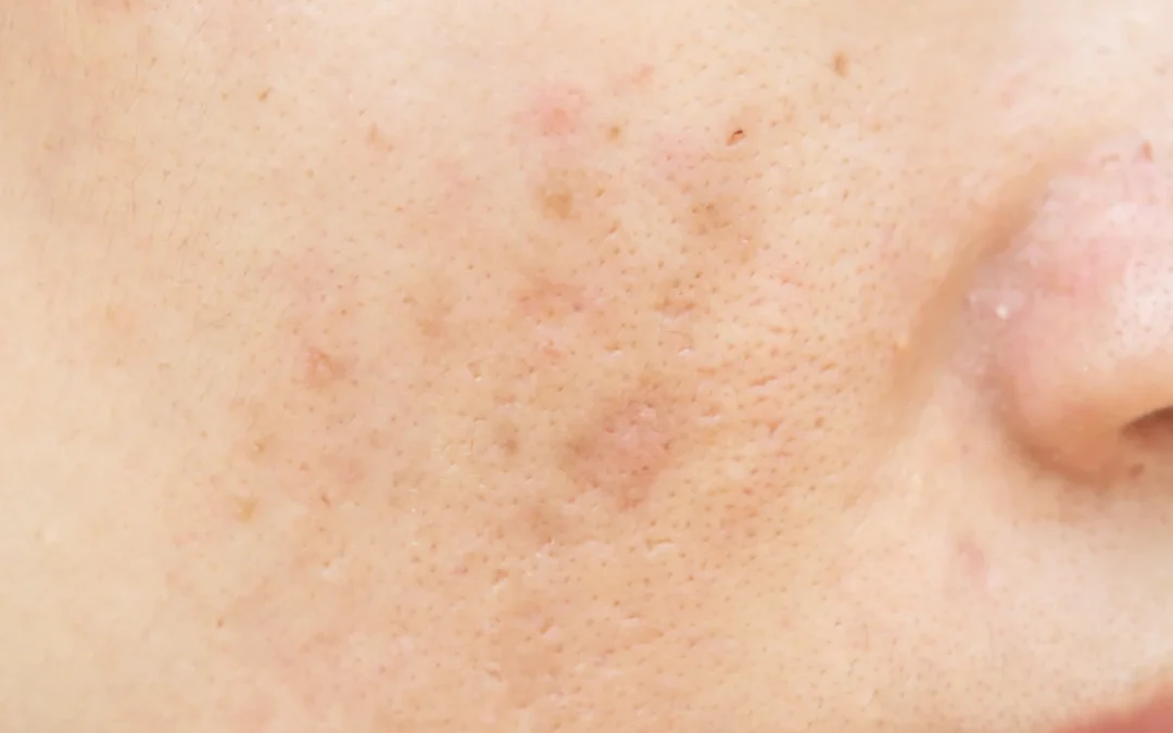 Laser Treatment for Dark Spots | What to Expect