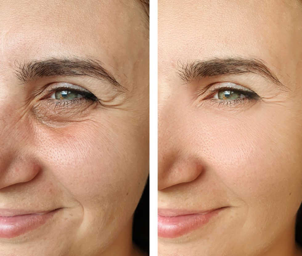 Powell, OH Facial Injections | Botox, Dermal & Facial Fillers